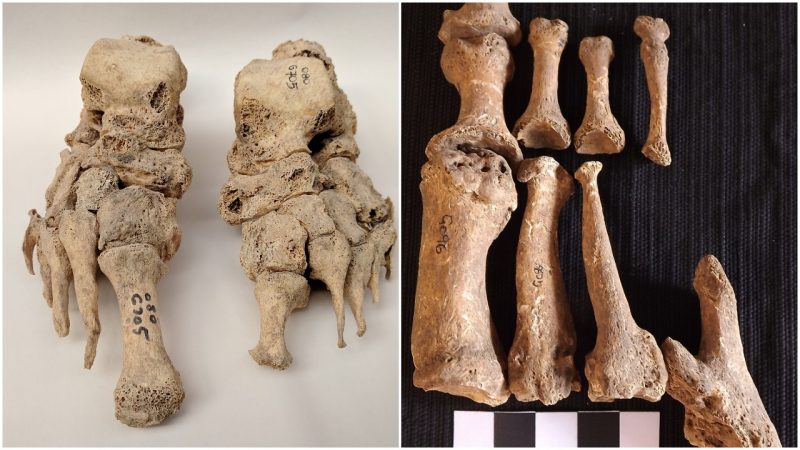 The remains of a leprosy victim from 5th century Britain leads to new ...