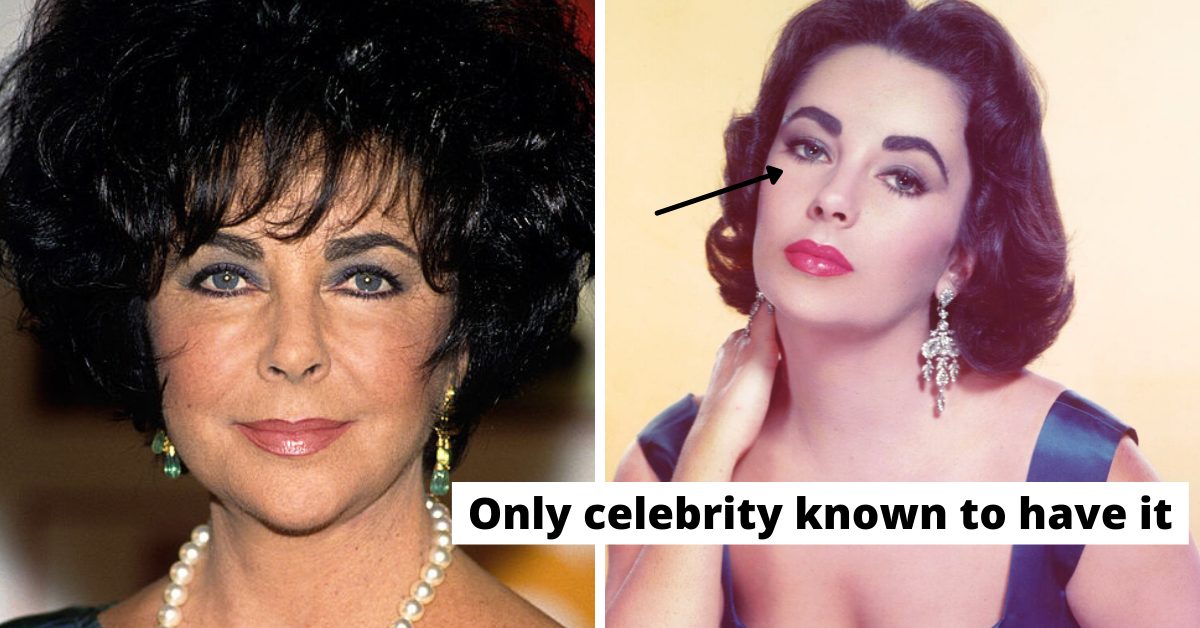 Elizabeth Taylor’s dark outlined eyes were due to a genetic mutation