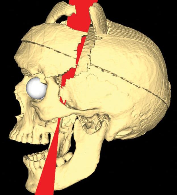 Phineas Gage-The bizarre story of how a railroad worker survived an ...