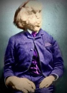 The Sad Life of the Real "Elephant Man" | The Vintage News