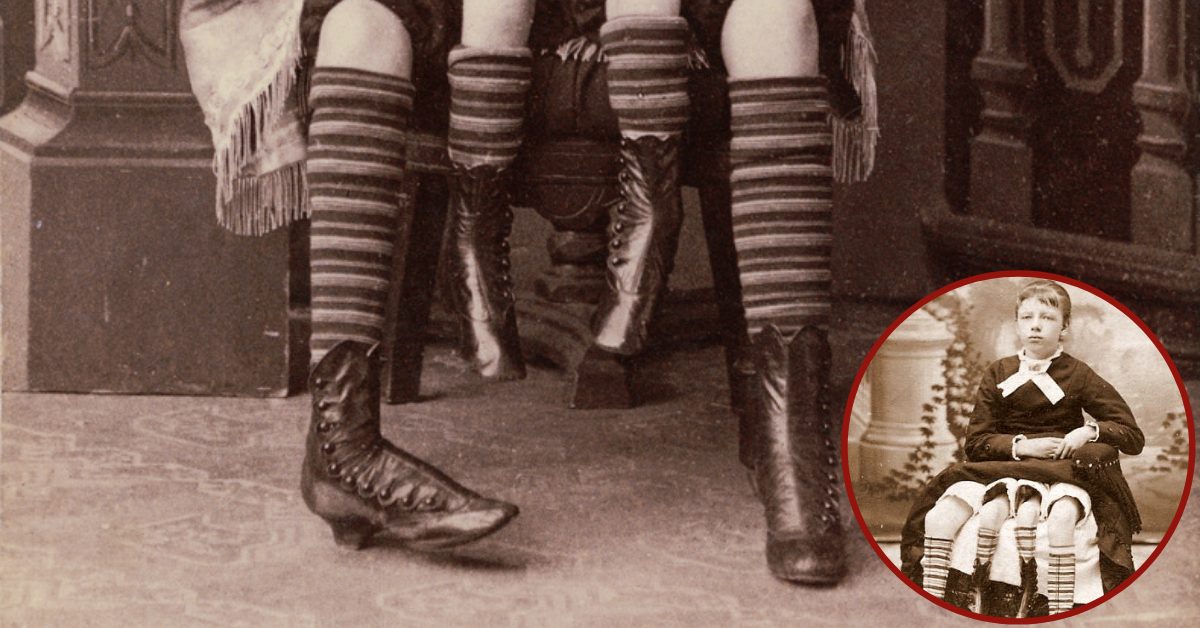 This Girl Was Deemed a 'Monster' for Having Four Legs | The Vintage News